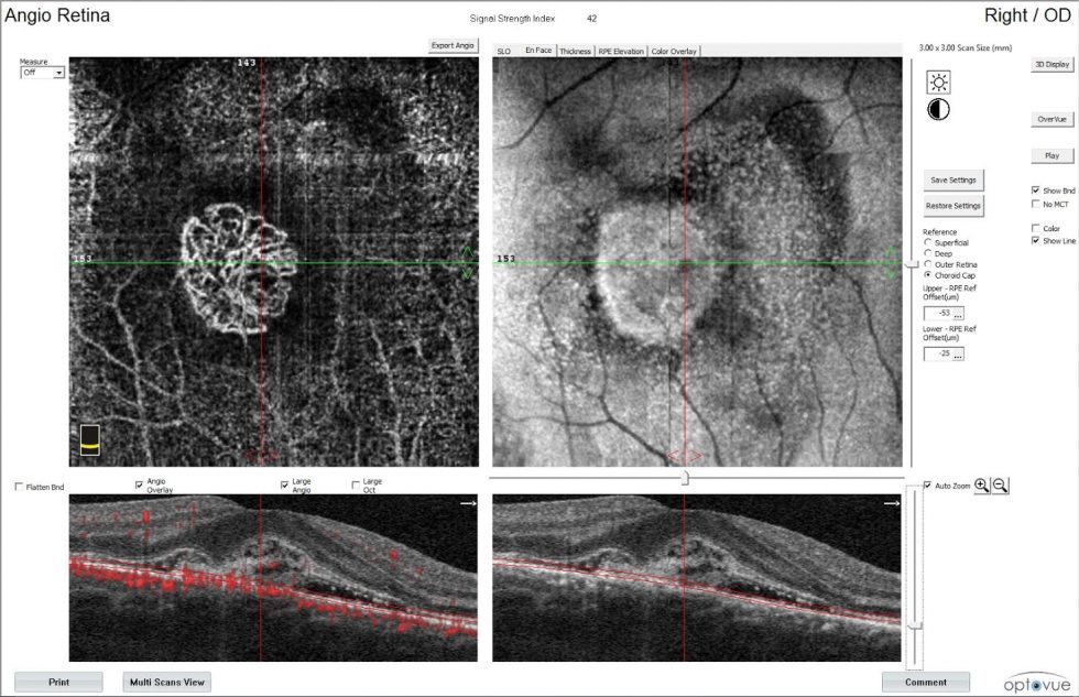 OCT e Angio OCT - Studio Oculistico d'Azeglio