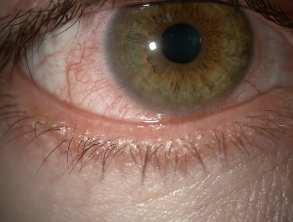 Blefariti - Studio Oculistico d'Azeglio